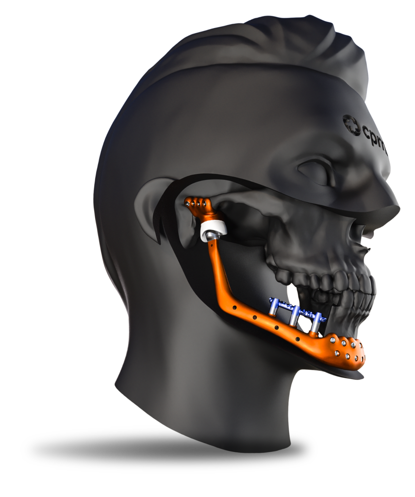 TMJ Prosthesis | CPMH Digital