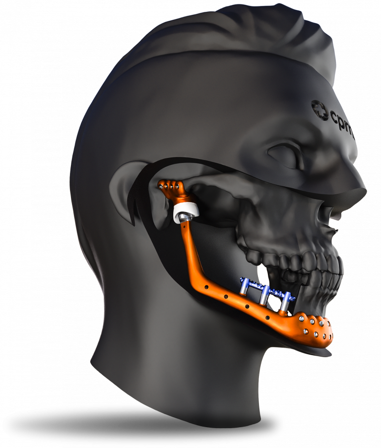 TMJ Prosthesis | CPMH Digital